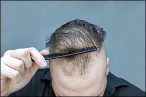 Genetics & Signs of Male Pattern Baldness in New Bedford, MA ...